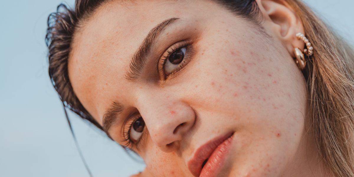 How Does PCOS Affect Skin Health? - Intelligent Labs